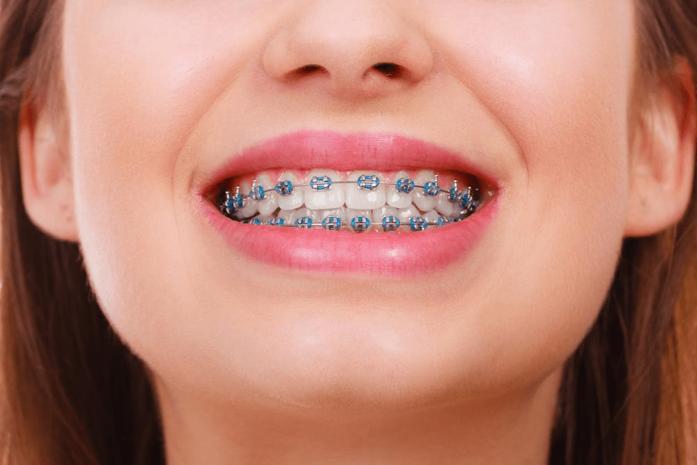 Brackets Para Niños Xátiva 醴 Expertos Odontología Infantil Clivadent